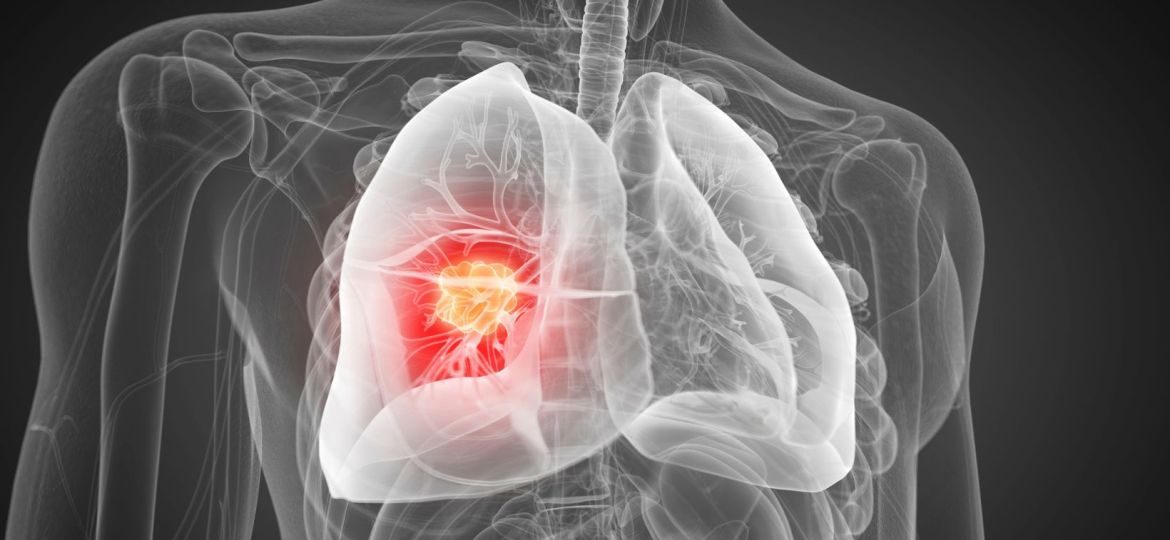 Panel de RNA para cáncer de pulmón: detecta mutaciones clave y evalúa ...
