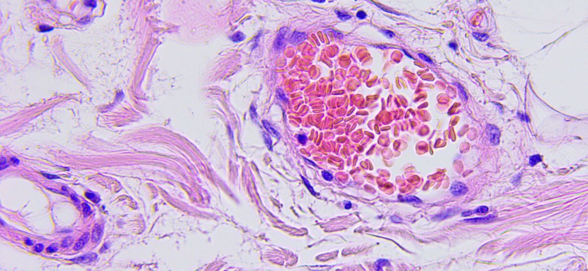 Detección de mutaciones del gen PIK3CA y su vinculación con el cáncer ...