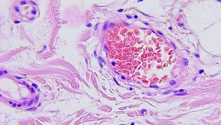 Detección de mutaciones del gen PIK3CA y su vinculación con el cáncer ...