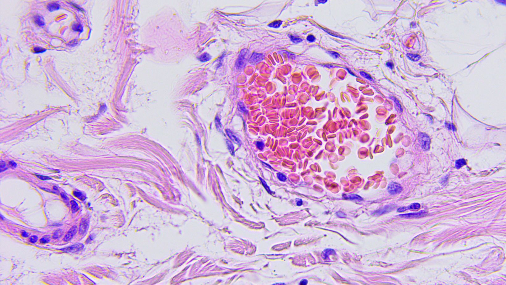 Detección de mutaciones del gen PIK3CA y su vinculación con el cáncer ...